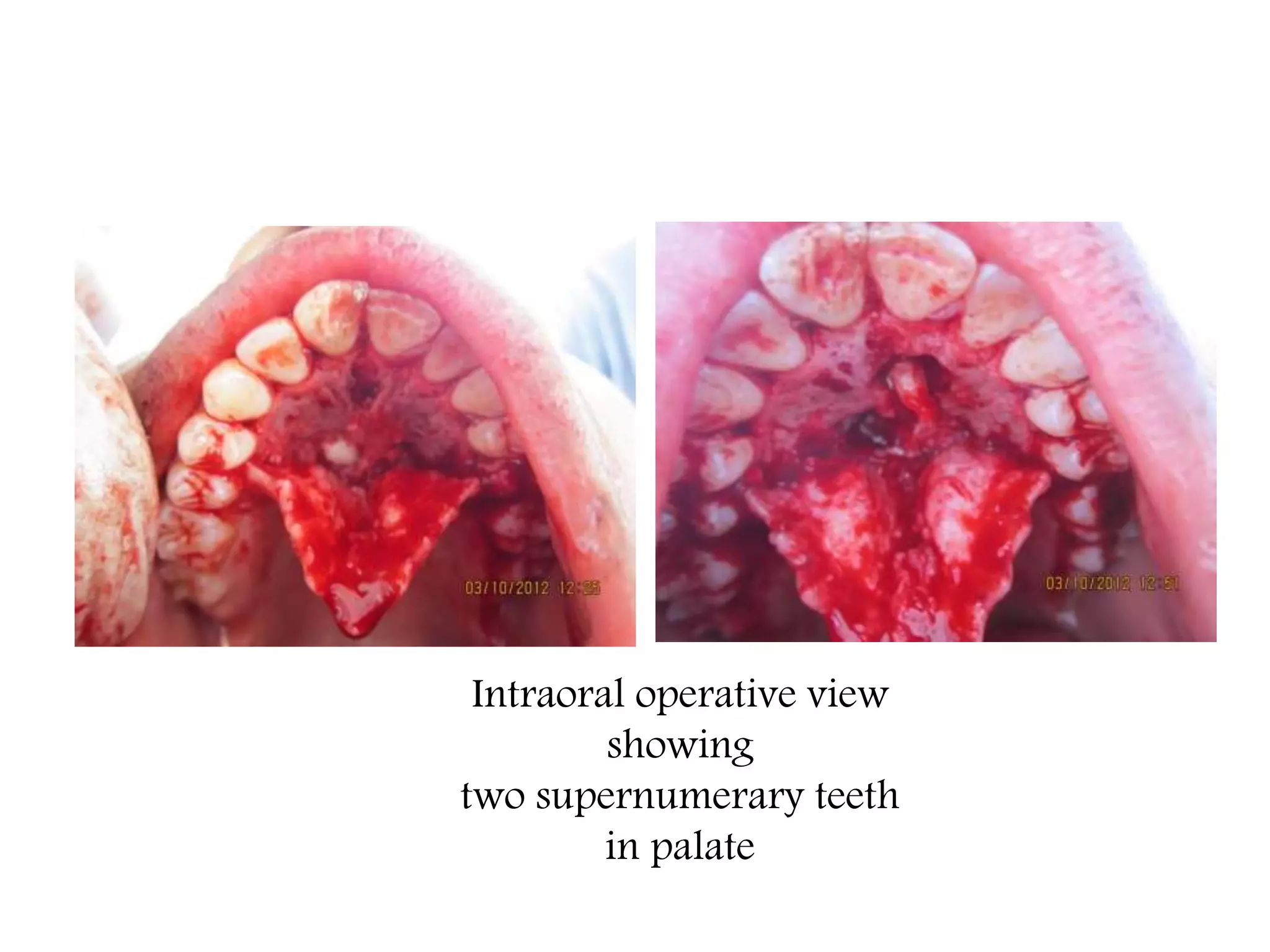 Impacted supernumerary | PPTX