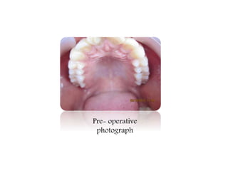Impacted supernumerary | PPTX