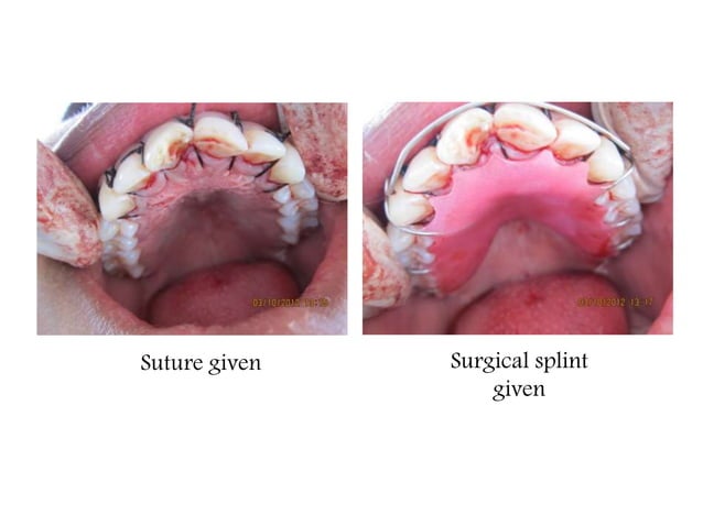 Impacted supernumerary | PPT