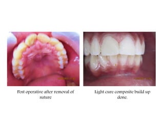 Impacted supernumerary | PPTX