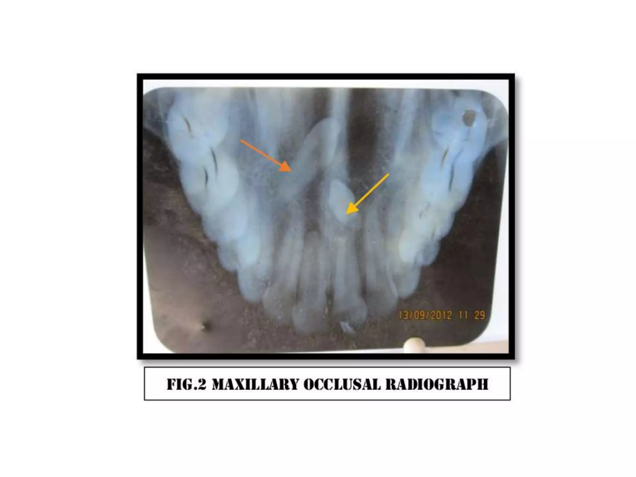 Impacted supernumerary teeth | PPTX