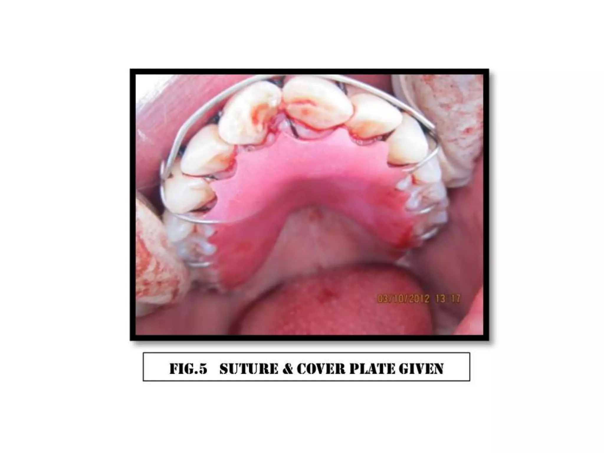 Impacted supernumerary teeth | PPTX
