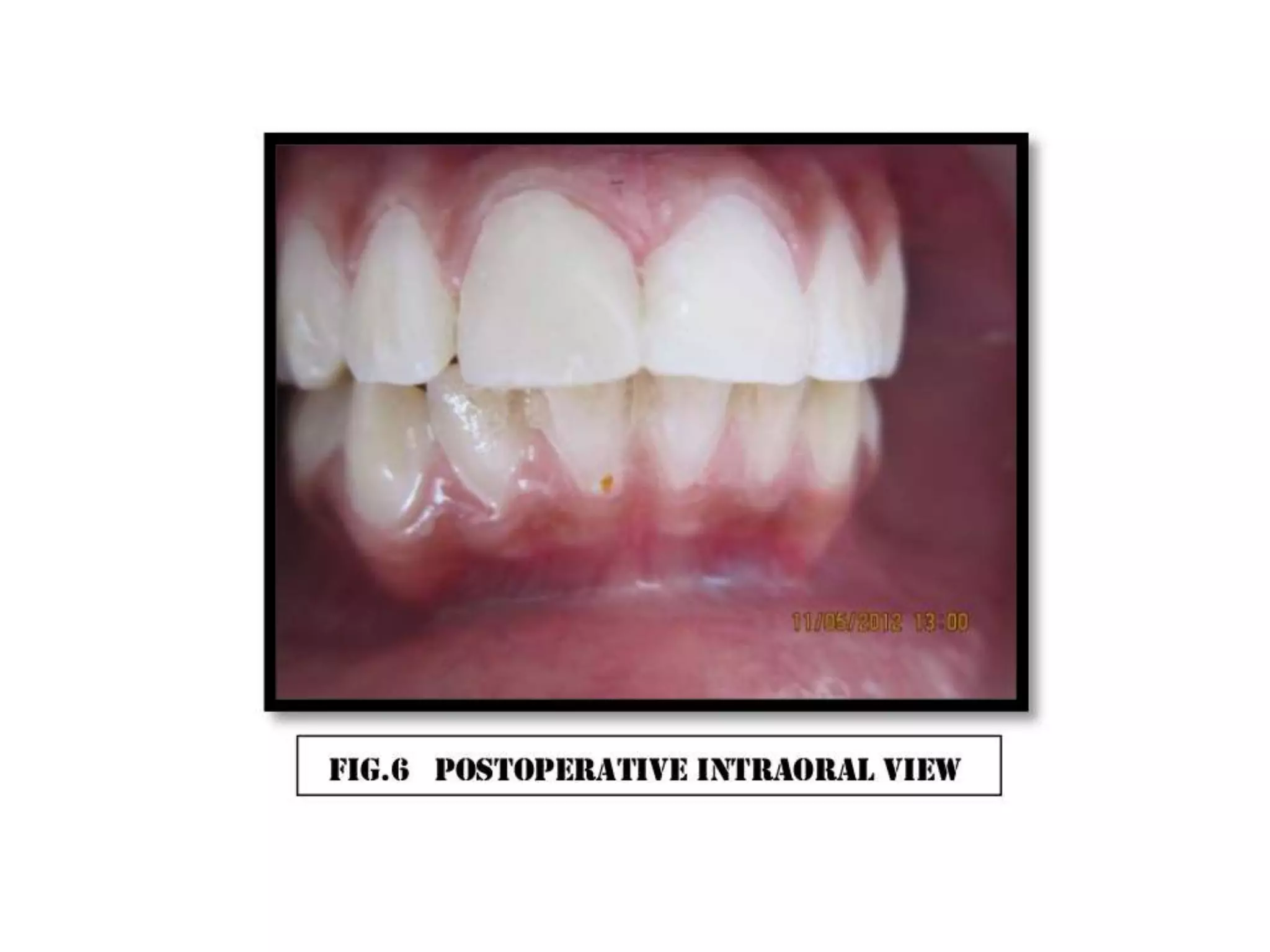 Impacted supernumerary teeth | PPTX