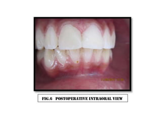 Impacted supernumerary teeth | PPTX | Dental Health | Diseases and ...