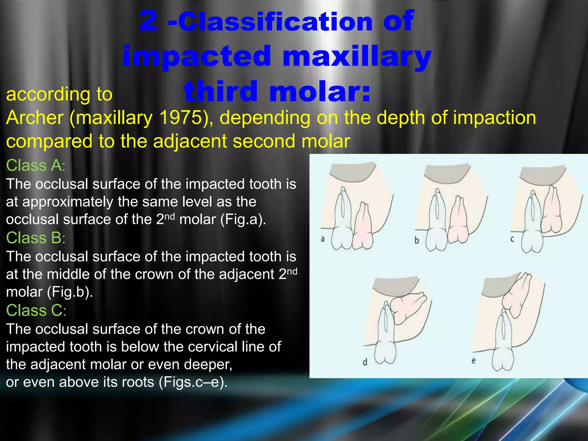 Impacted teeth | PDF