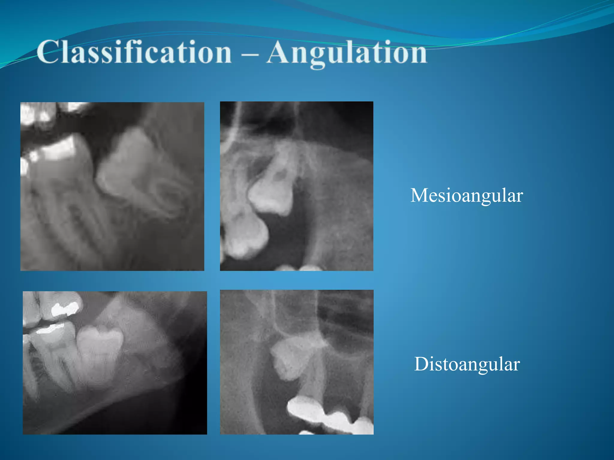 Impacted teeth | PPTX