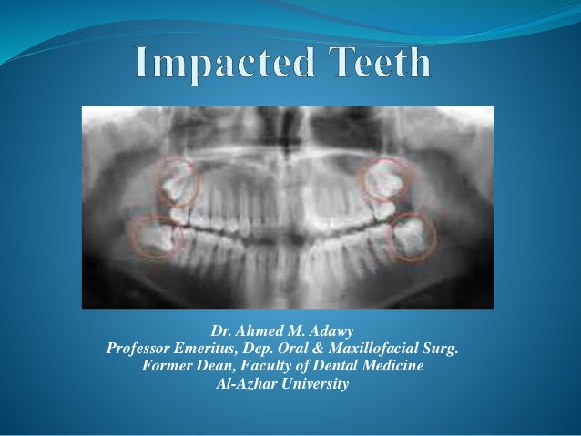 Impacted teeth