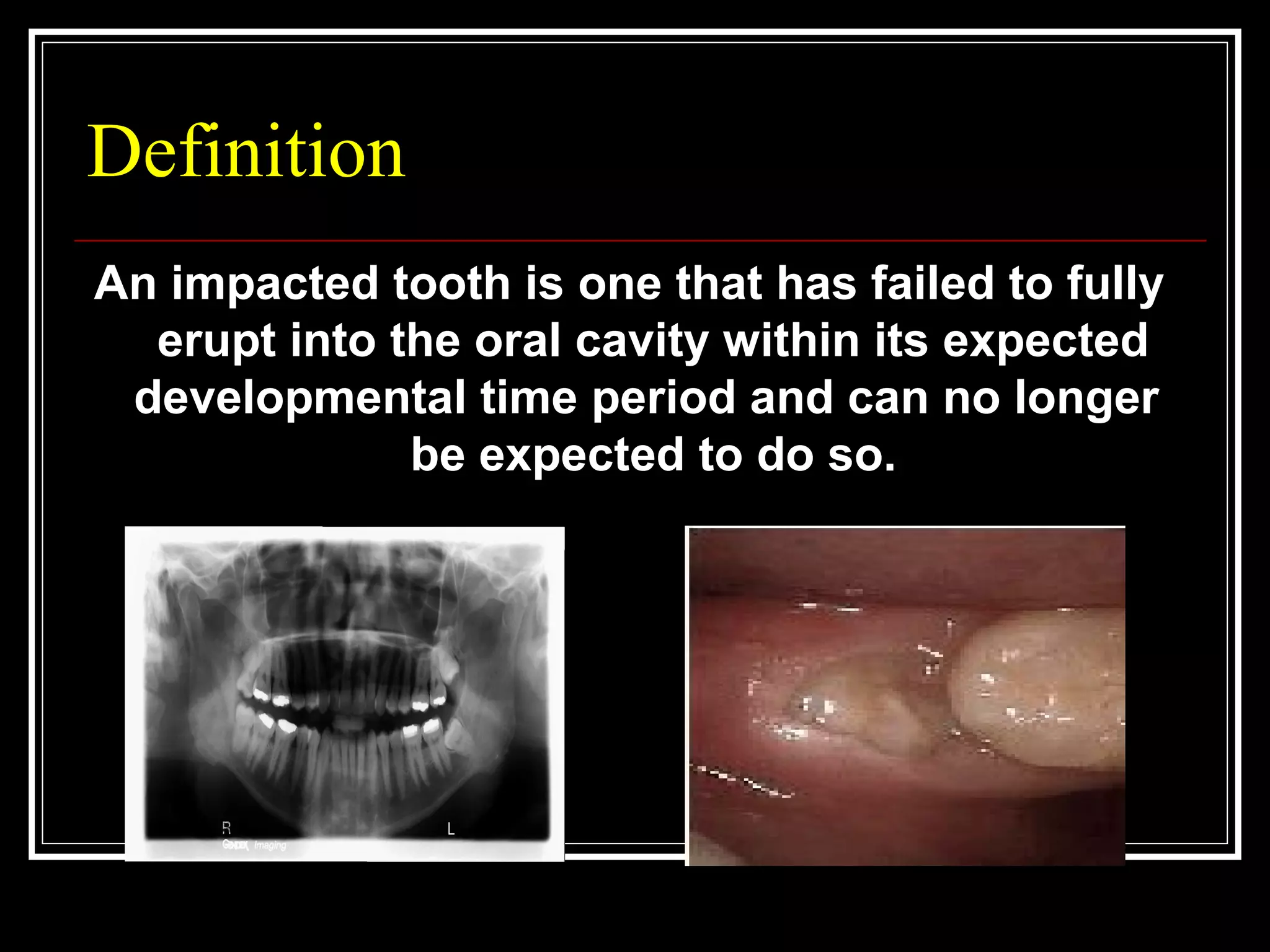 Impacted teeth | PPT
