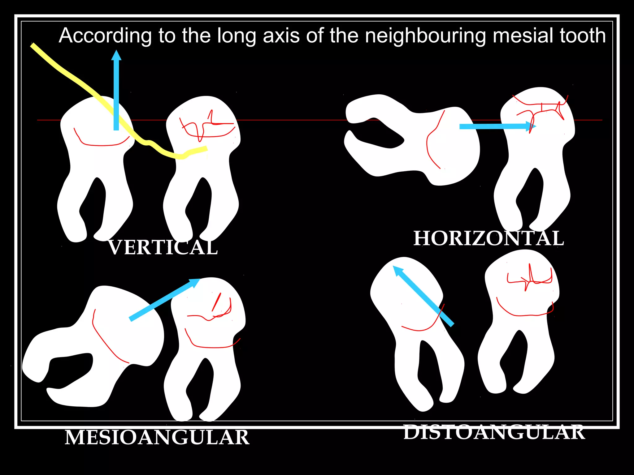 Impacted teeth | PPT