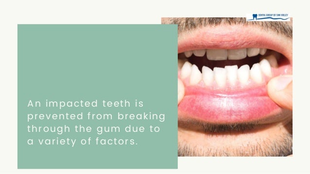 Impacted Teeth The Causes and Impacts to Your Dental Health | PPTX