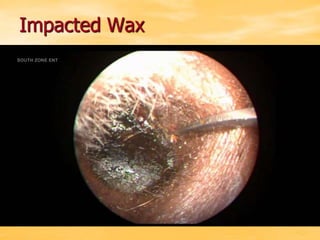 Impacted wax | PPT