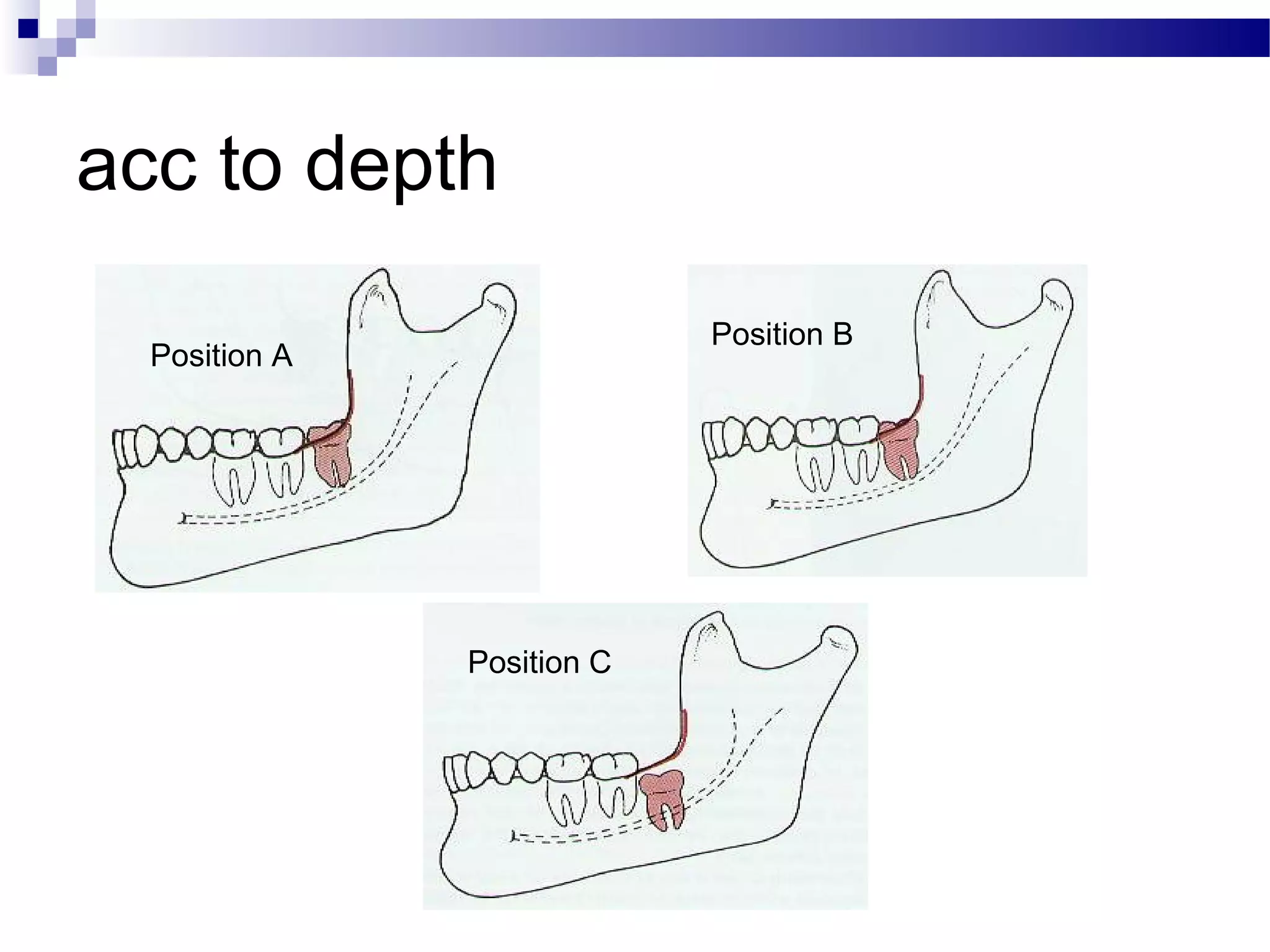 Impaction | PPT