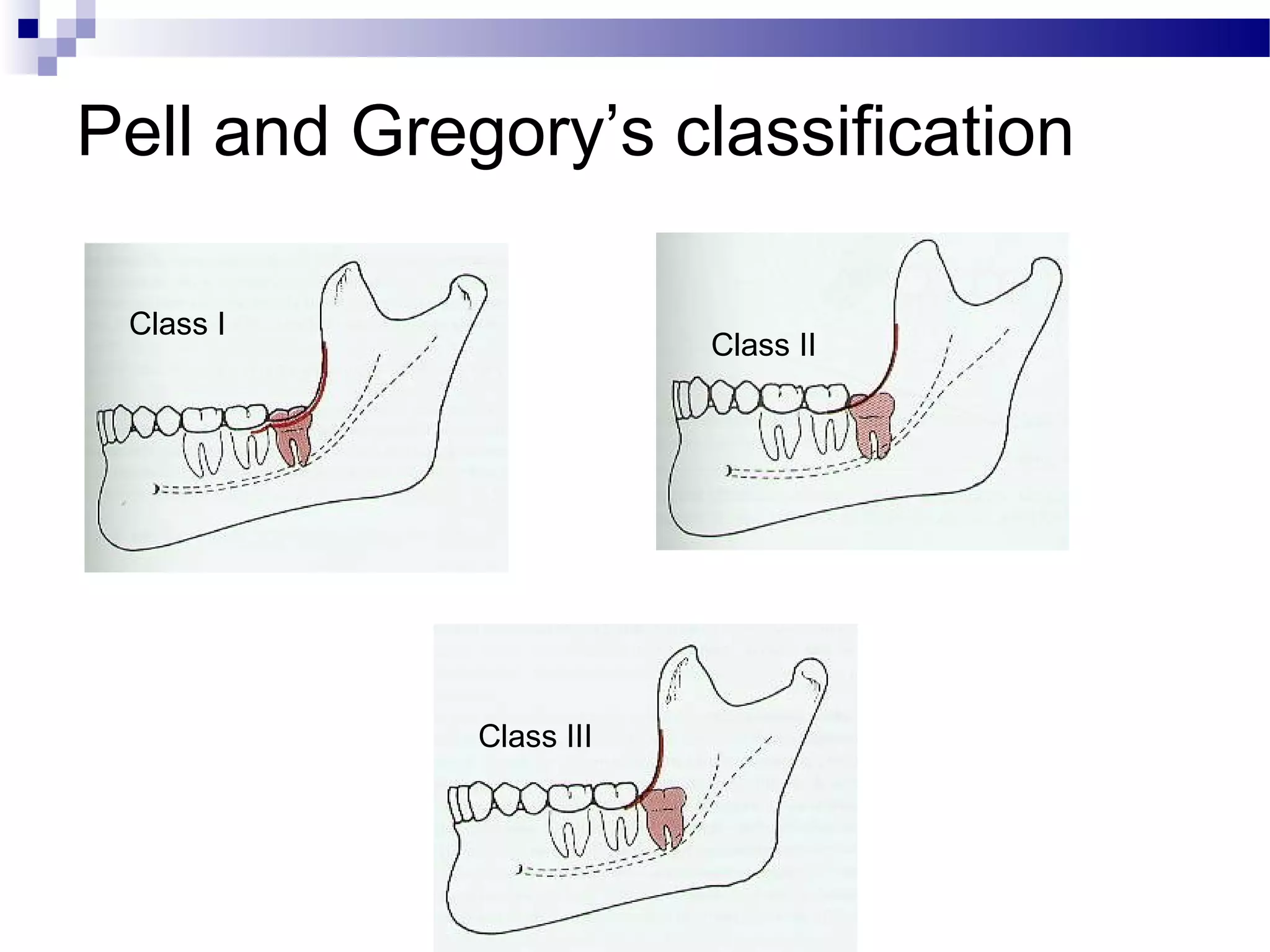 Impaction | PPT
