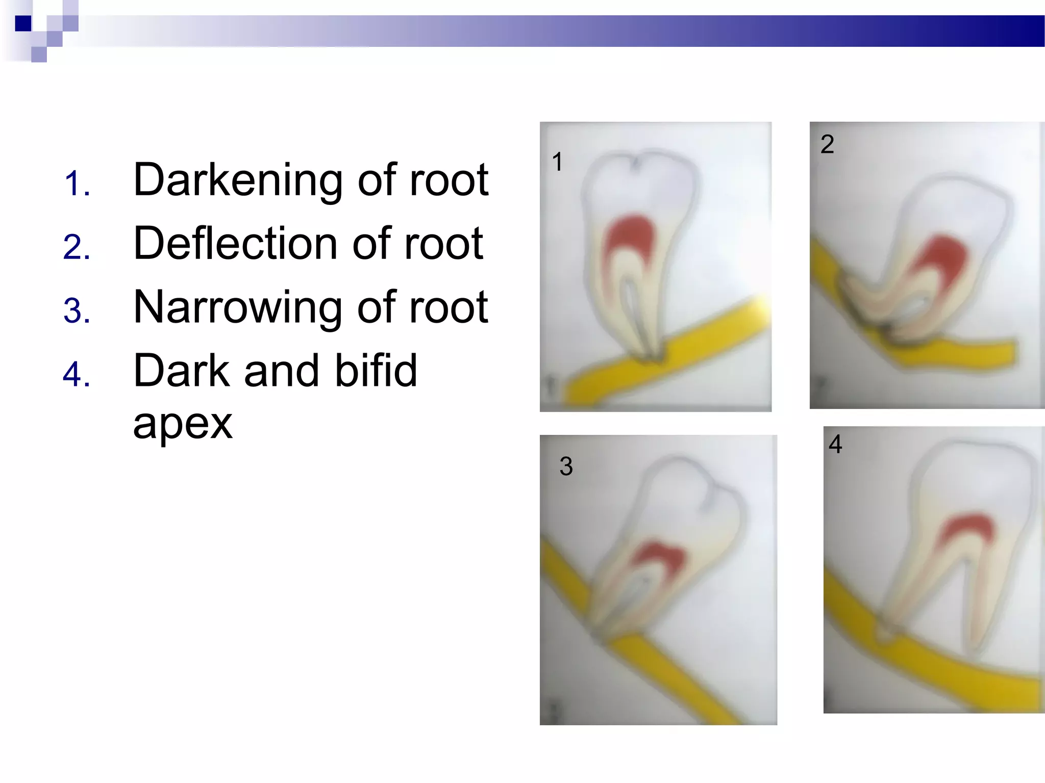 Impaction | PPT