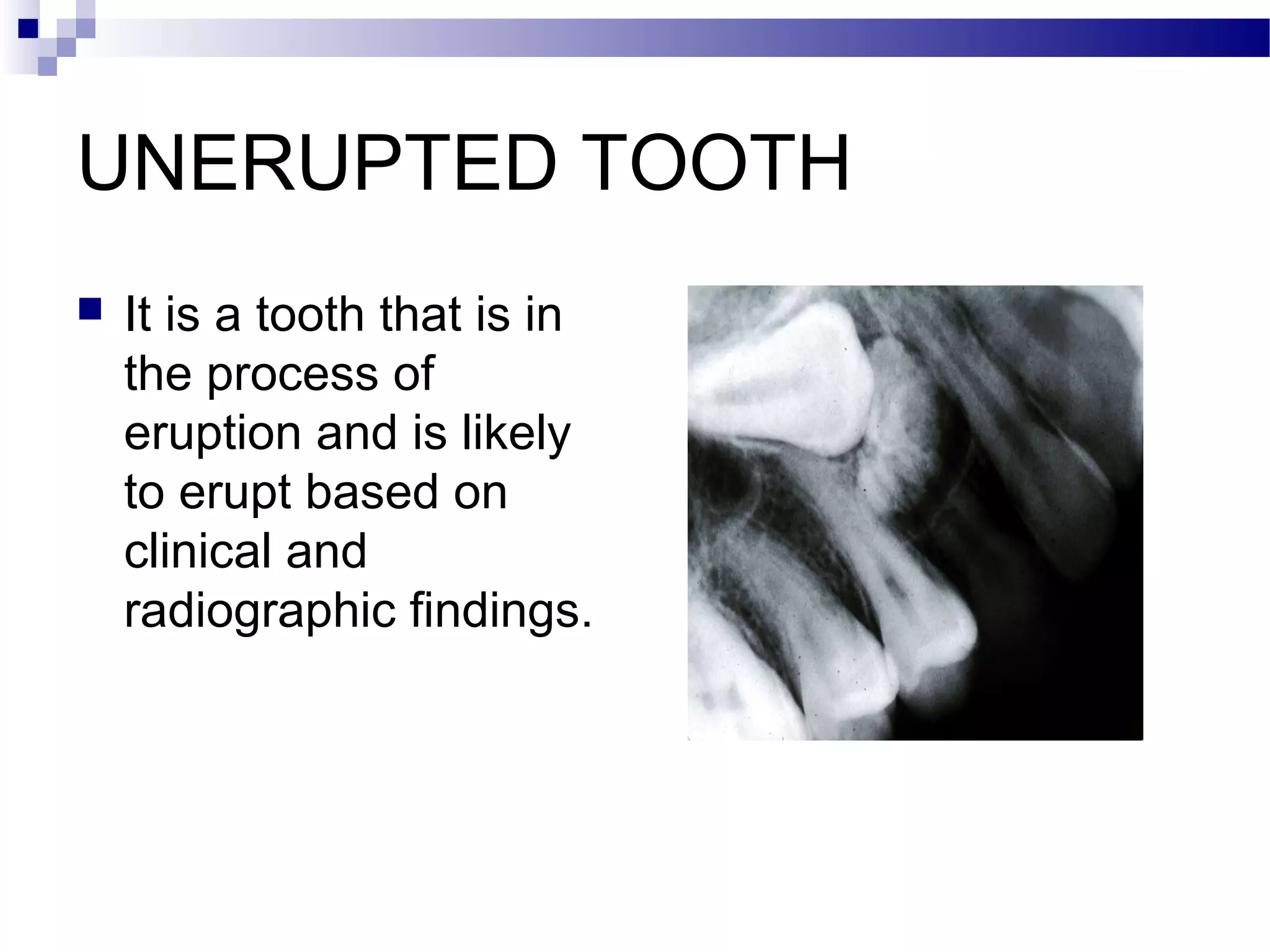 Impaction | PPT