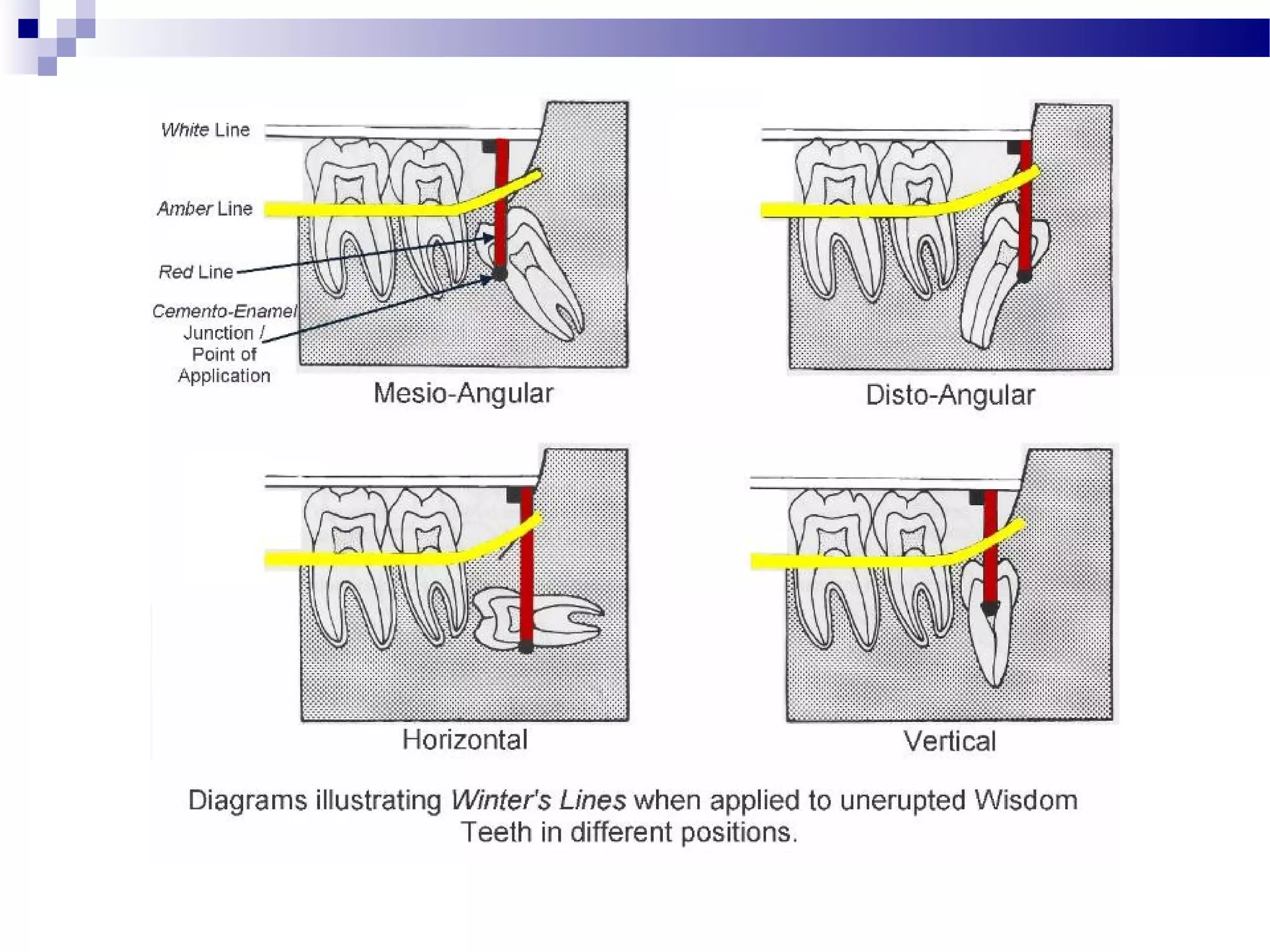 Impaction | PPT