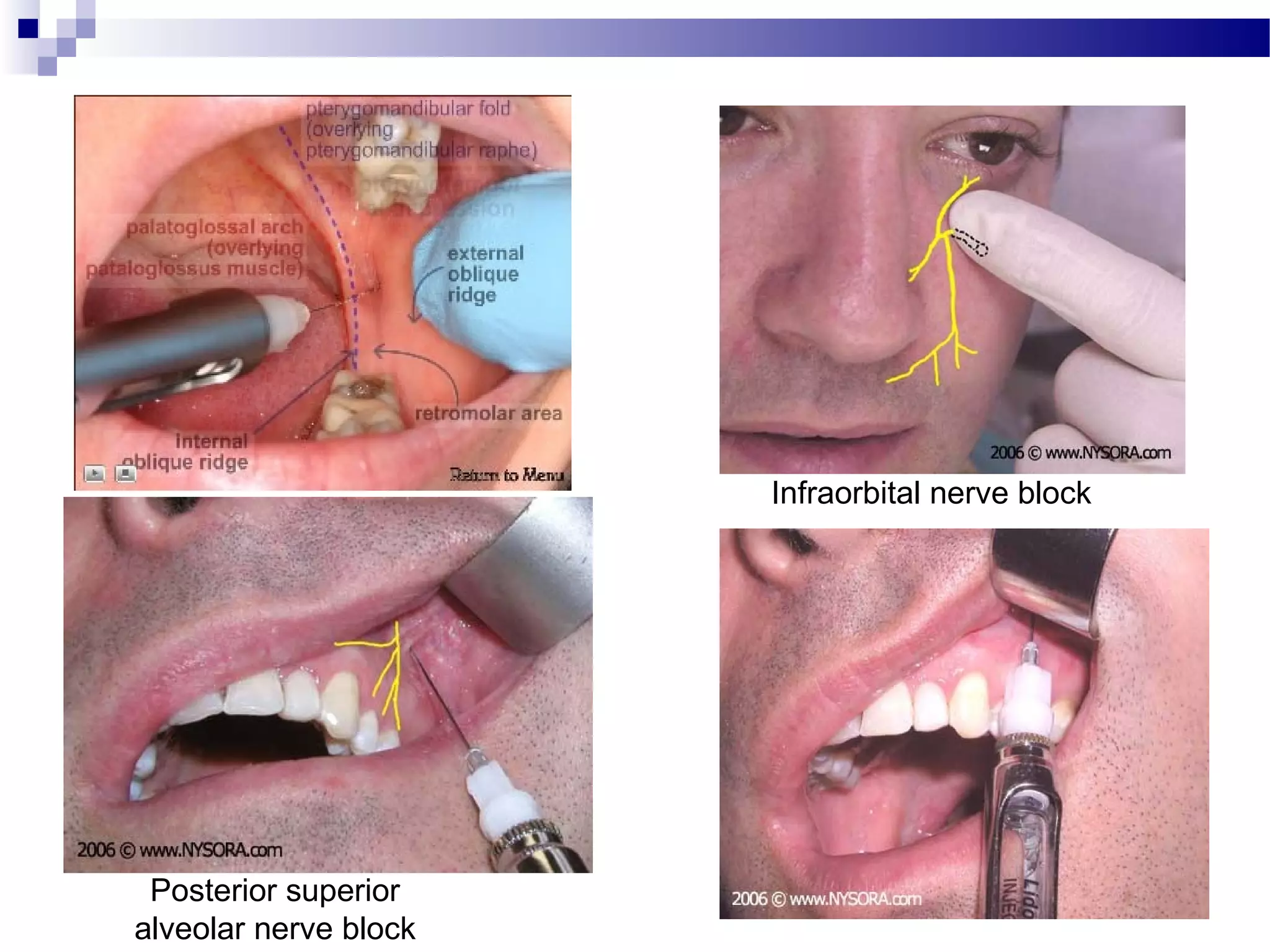 Impaction | PPT