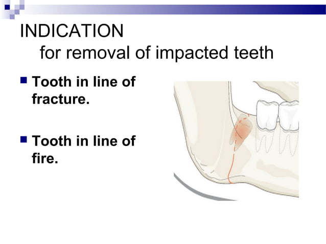 Impaction | PPT