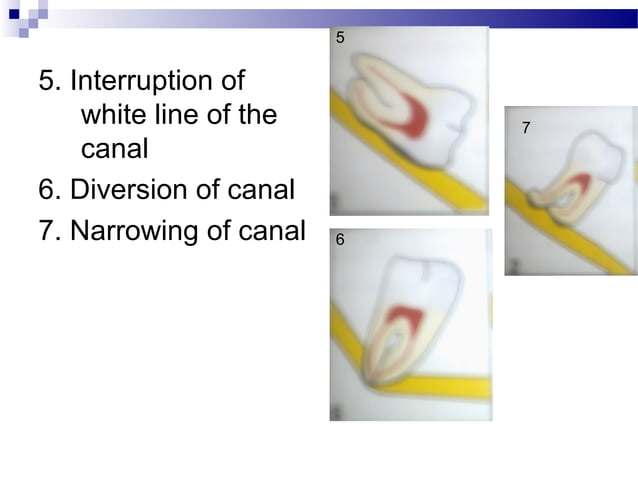 Impaction | PPT