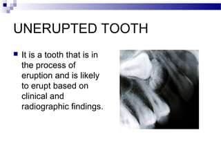 Impaction | PPT