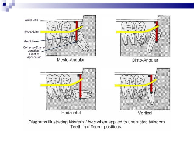 Impaction | PPT