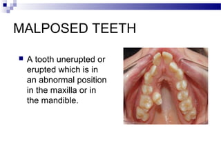 Impaction | PPT