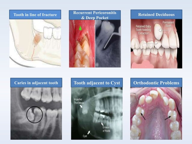 Impaction | PPTX | Dental Health | Diseases and Conditions