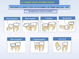 Impaction | PPTX