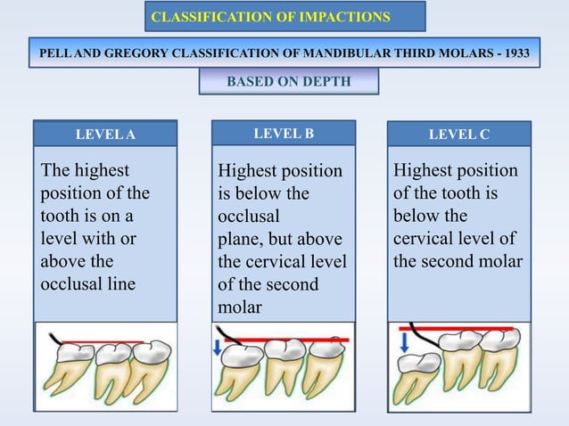 Impaction | PPTX | Dental Health | Diseases and Conditions