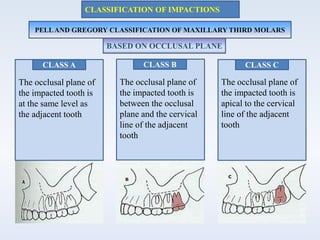 Impaction | PPTX