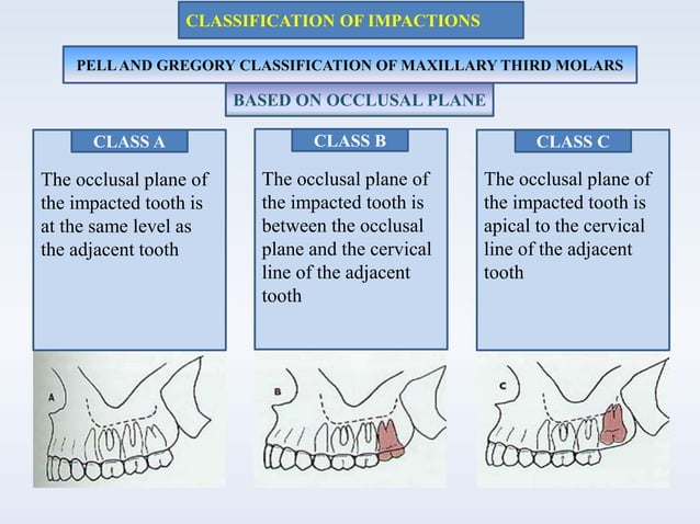 Impaction | PPTX | Dental Health | Diseases and Conditions