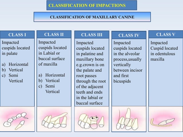 Impaction | PPTX | Dental Health | Diseases and Conditions