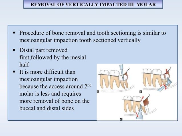 Impaction | PPTX | Dental Health | Diseases and Conditions