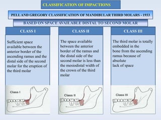 Classification System Of Impacted Mandibular 3rd Molar Pell, 46% OFF