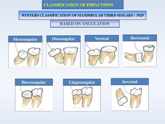 Impaction