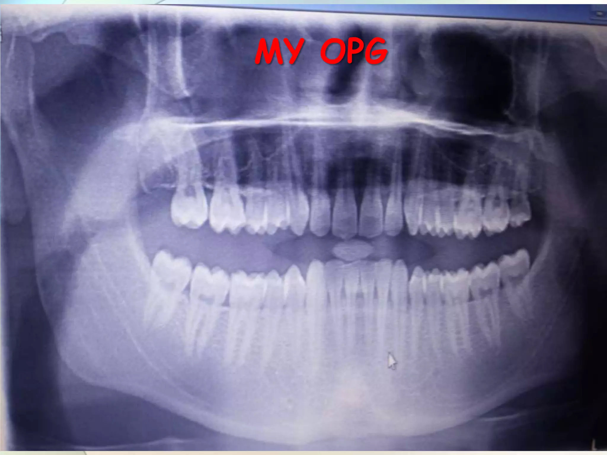 IMPACTION IN ORAL SURGERY | PPTX