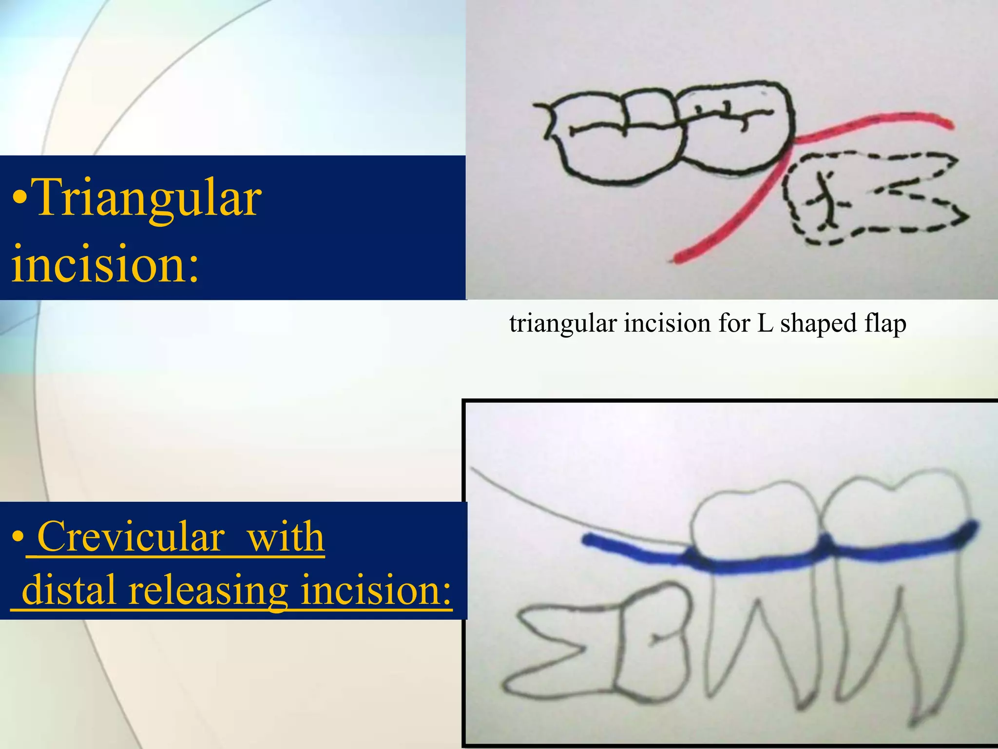 IMPACTION IN ORAL SURGERY | PPTX