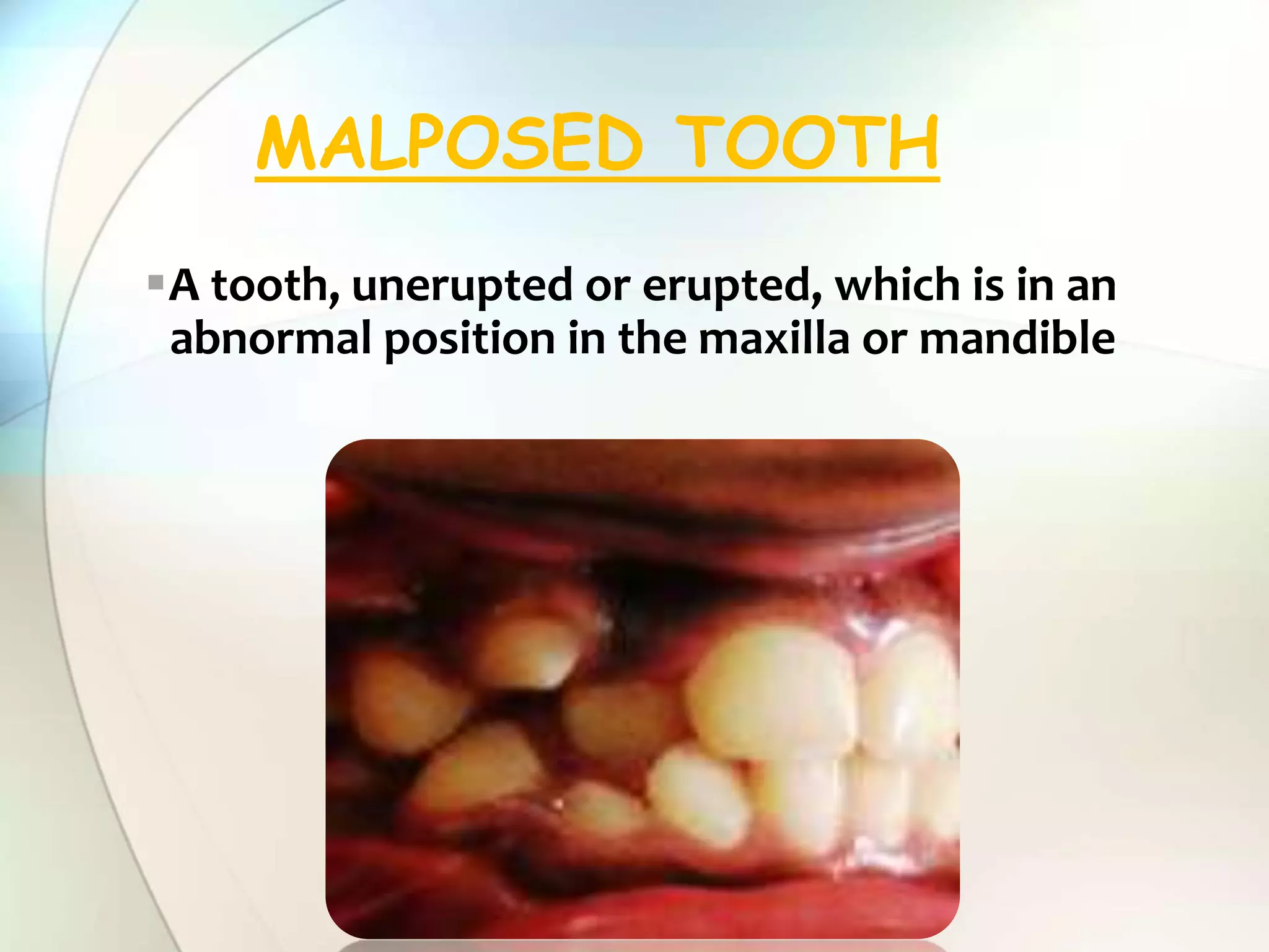 IMPACTION IN ORAL SURGERY | PPTX