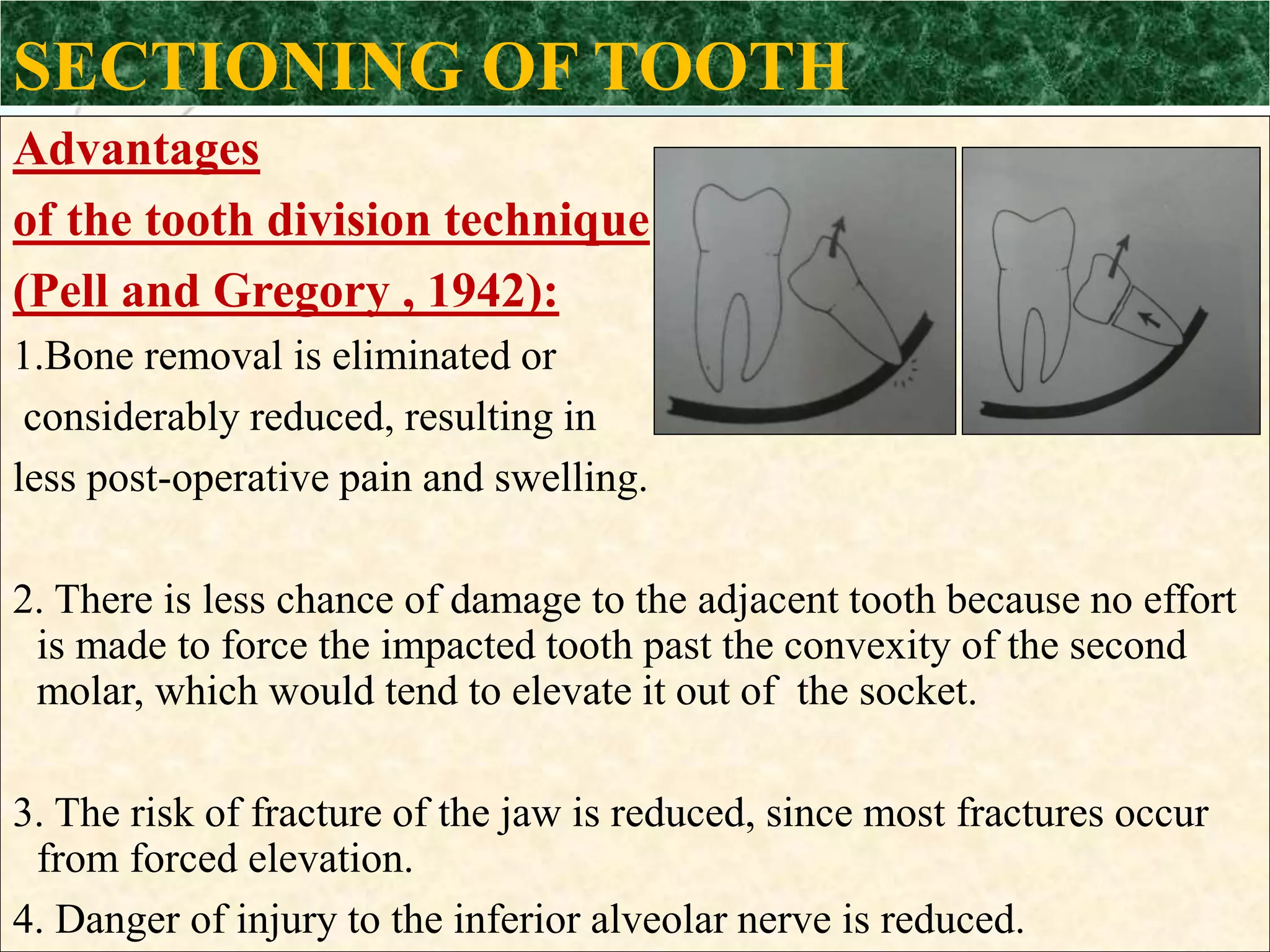 IMPACTION IN ORAL SURGERY | PPTX