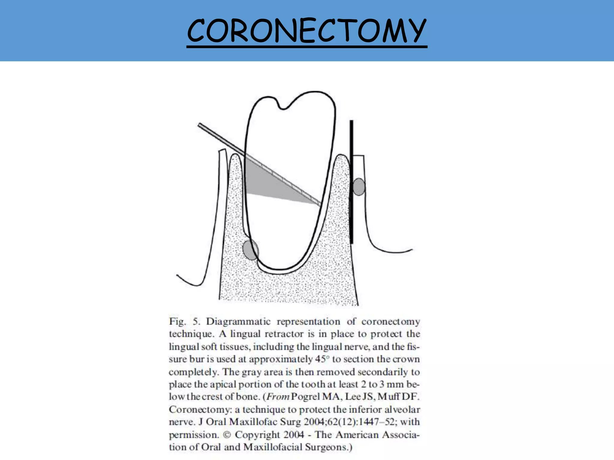 IMPACTION IN ORAL SURGERY | PPTX