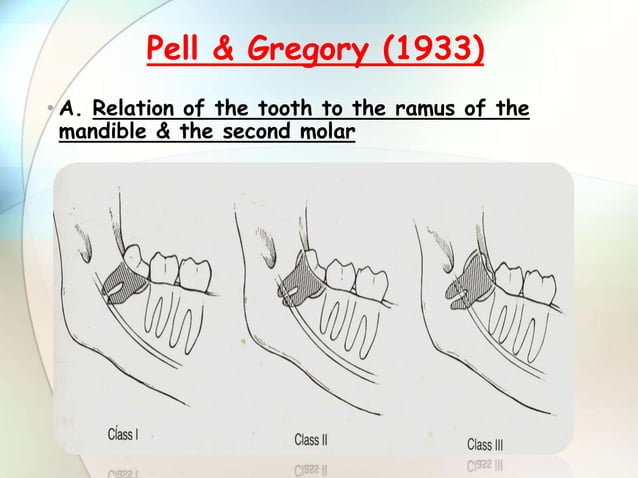 IMPACTION IN ORAL SURGERY | PPTX