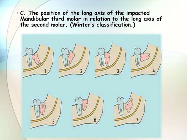IMPACTION IN ORAL SURGERY | PPTX