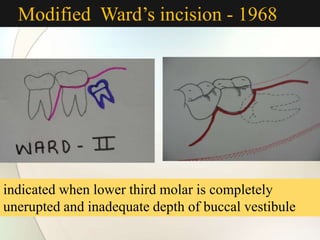 IMPACTION IN ORAL SURGERY | PPTX
