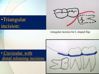 IMPACTION IN ORAL SURGERY | PPTX