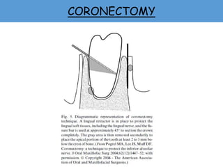 IMPACTION IN ORAL SURGERY | PPTX
