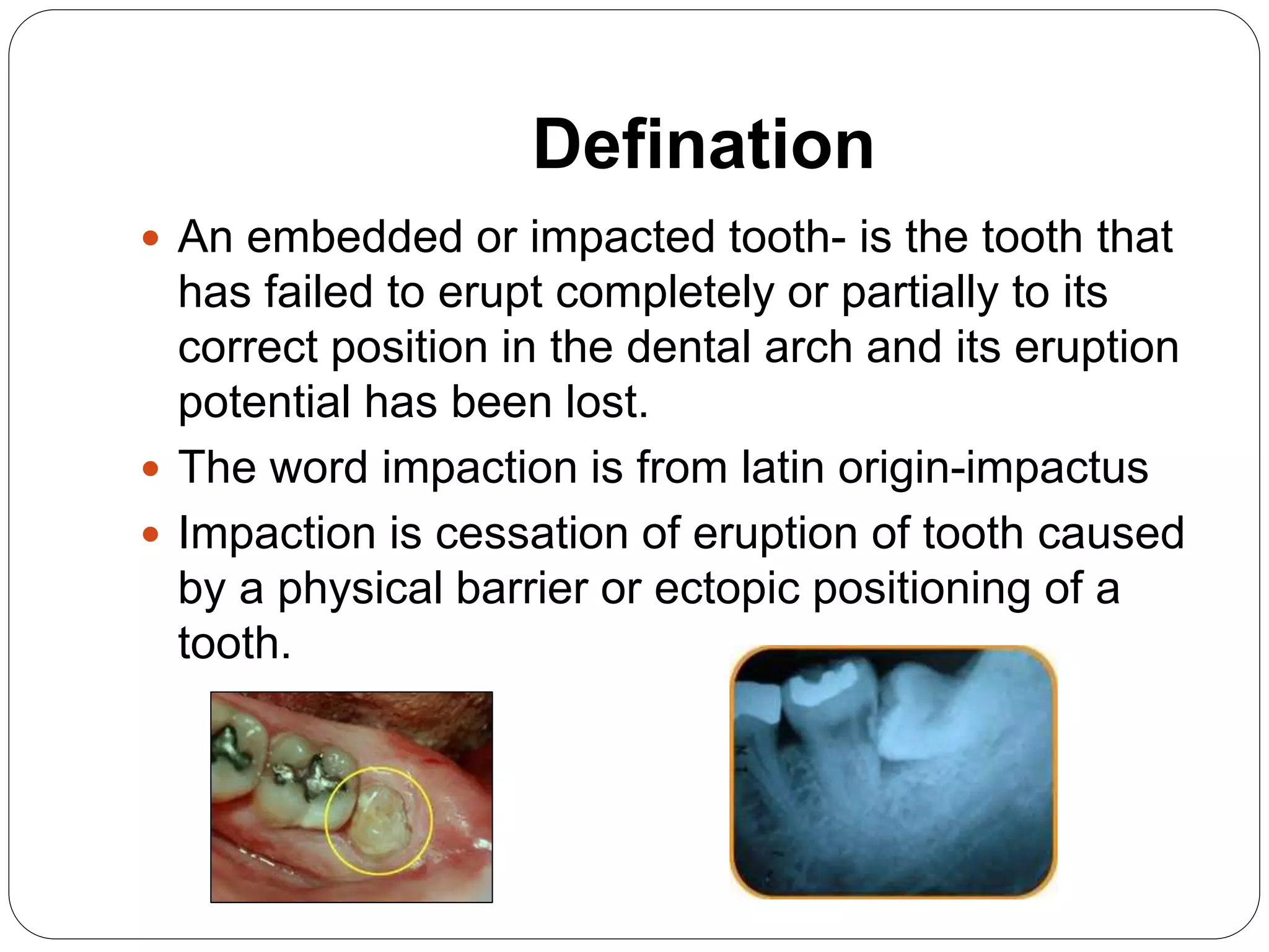 Impaction | PPTX | Dental Health | Diseases and Conditions