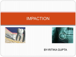 Impaction | PPTX