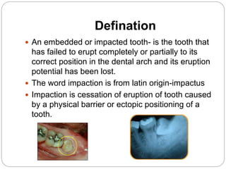Impaction | PPTX