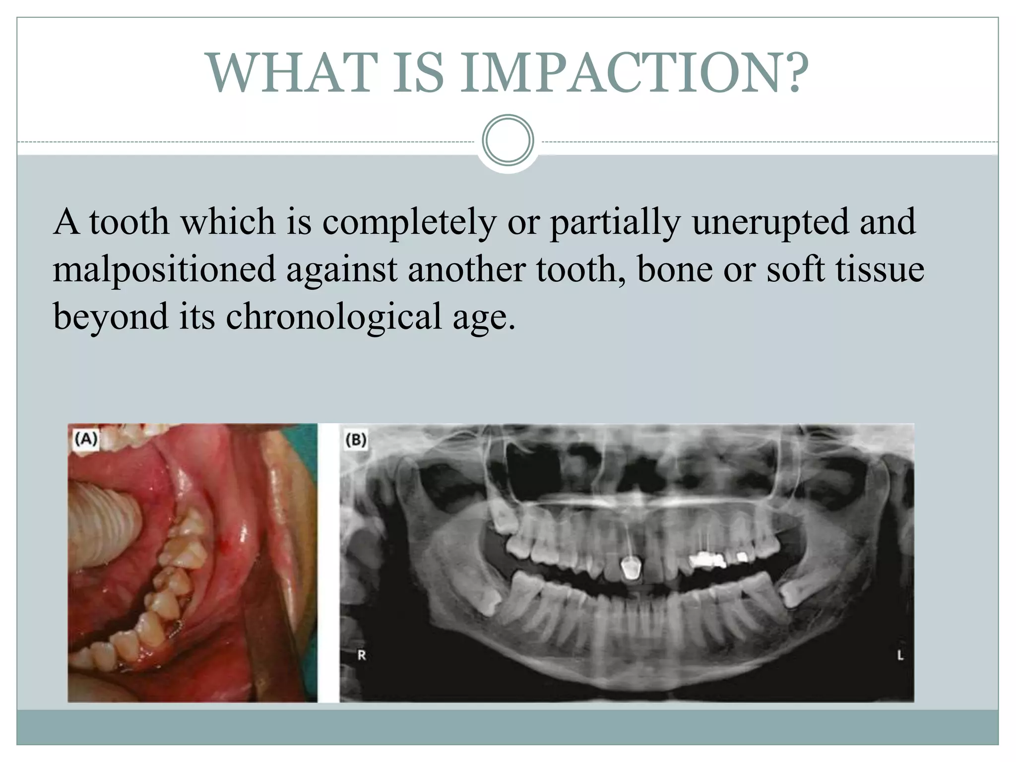 Impaction | PPTX