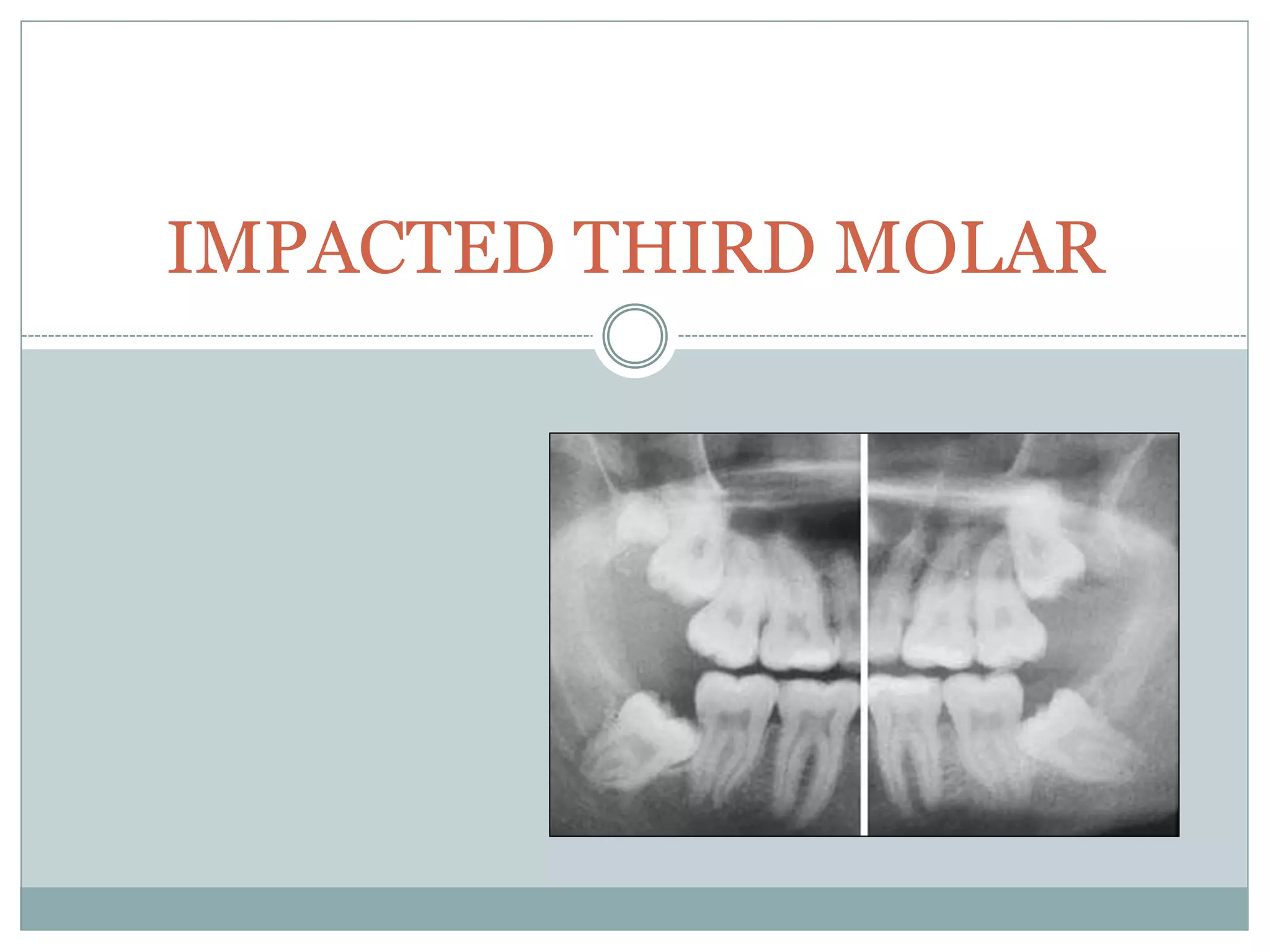 Impaction | PPTX